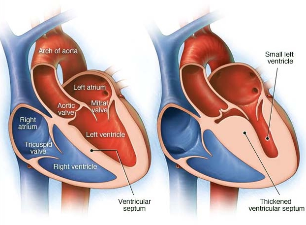 Miocardiopatia Hipertrófica: Hipertrofia do coração | Dr. Ricardo Contesini